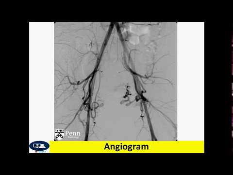 Uterine arteriovenous malformation. Prolong menstruation or bleeding after having sexual intercourse