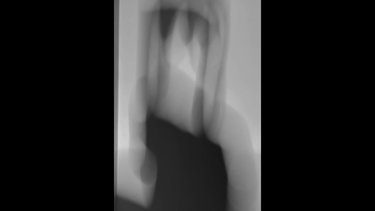 Negative Overlay Shadow Study