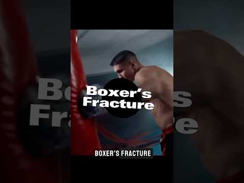 Boxer’s Fractures: What you need to know 👊🦴 #shorts