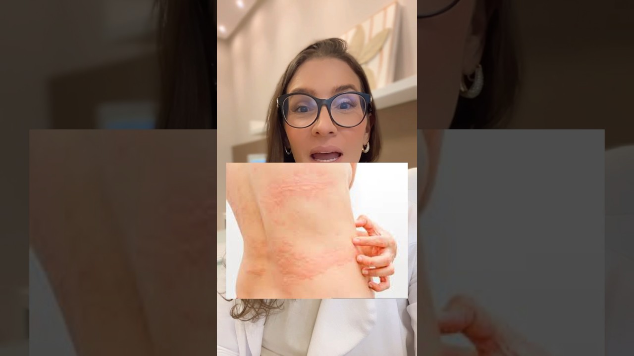Urticária aguda é alergia? #alergista #alergia #urticaria