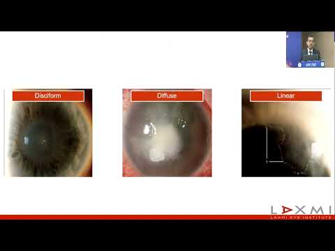 AIOC2022 IC307 topic Dr Niket Gandhi HSV ENDOTHELITIS ALL THAT YOU NEED TO KNOW
