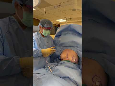 mastopexy with the anchor incision