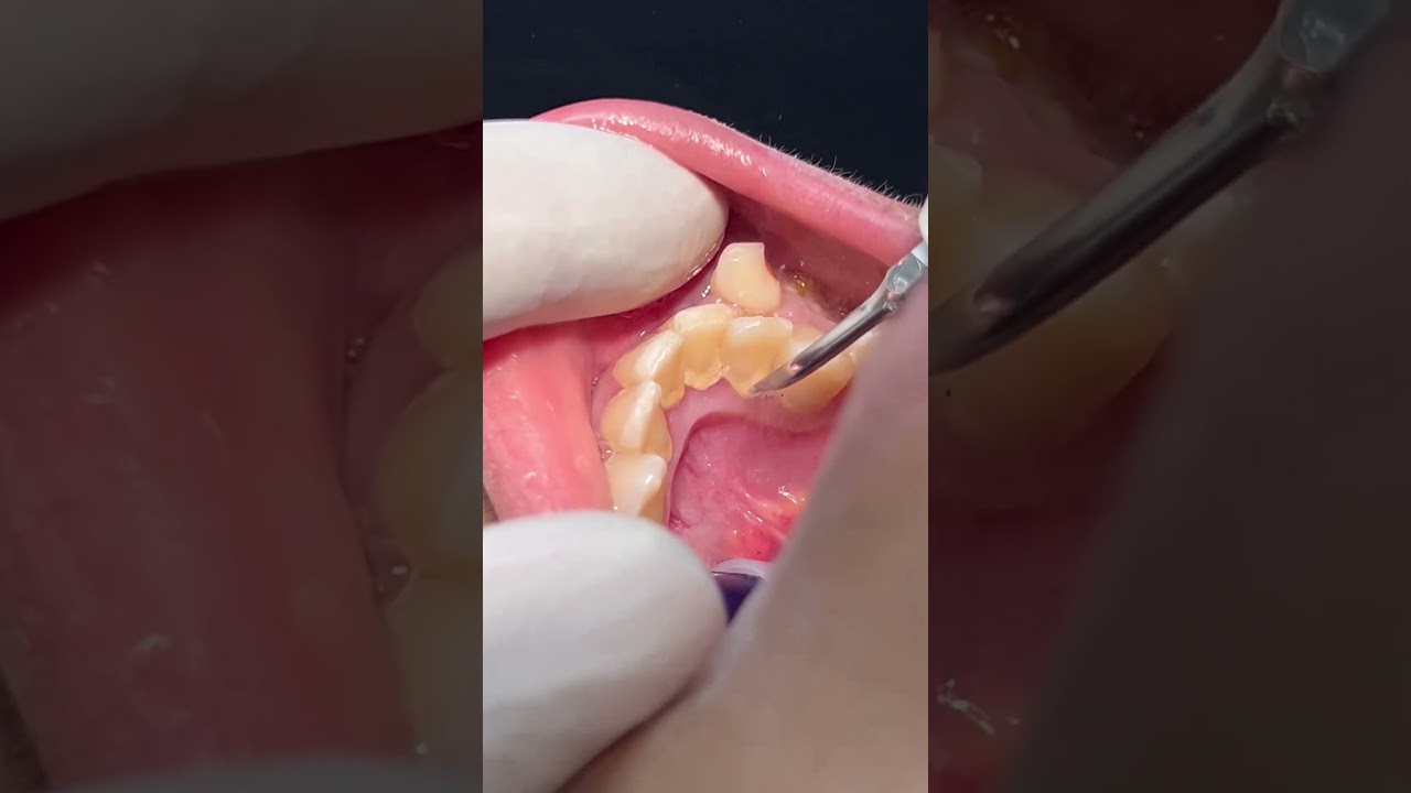 Scaling tartar and calculus #dental #dentist #dentistry