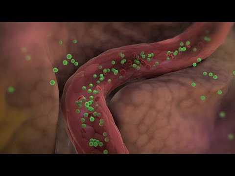 Síndrome de Ovario Poliquístico (PCOS)