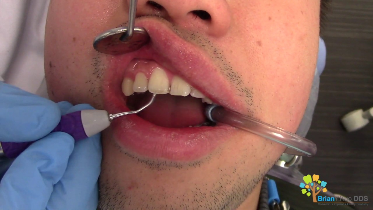 Dental Cleaning to remove tartar and clean a little below gum line.
