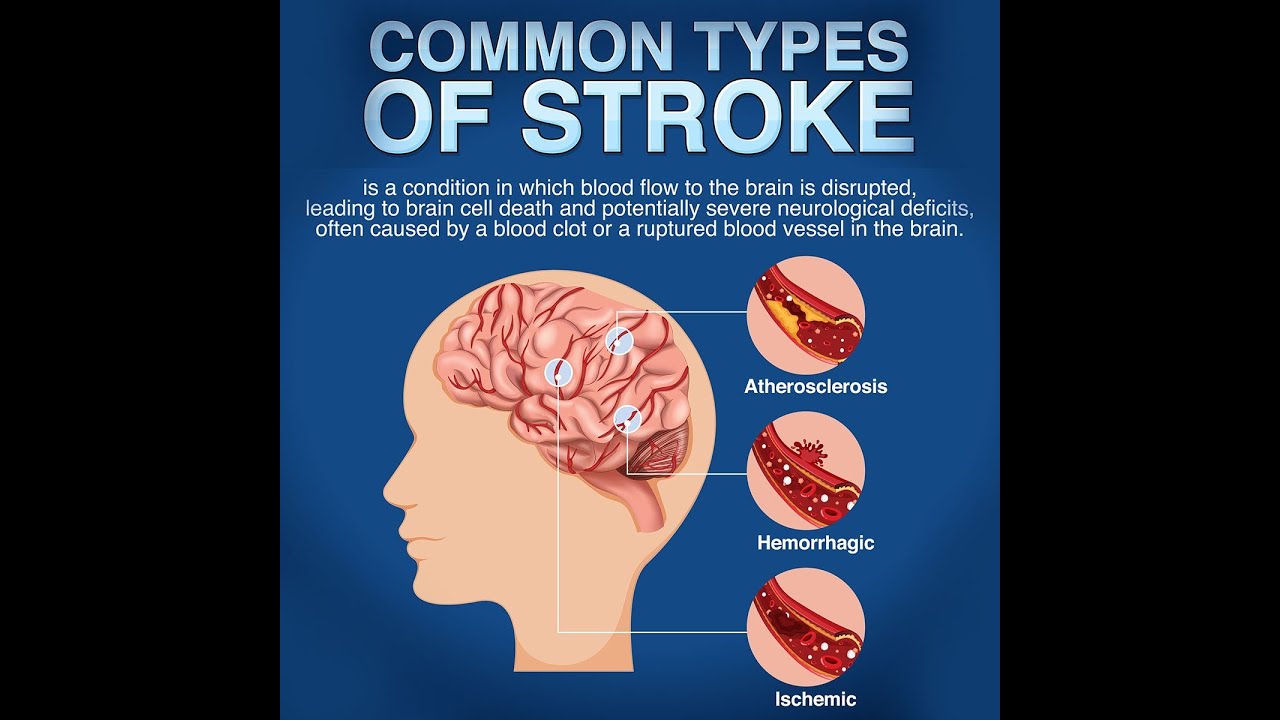 Meningitis | Stroke | Ischemia | cerebrovascular diseases