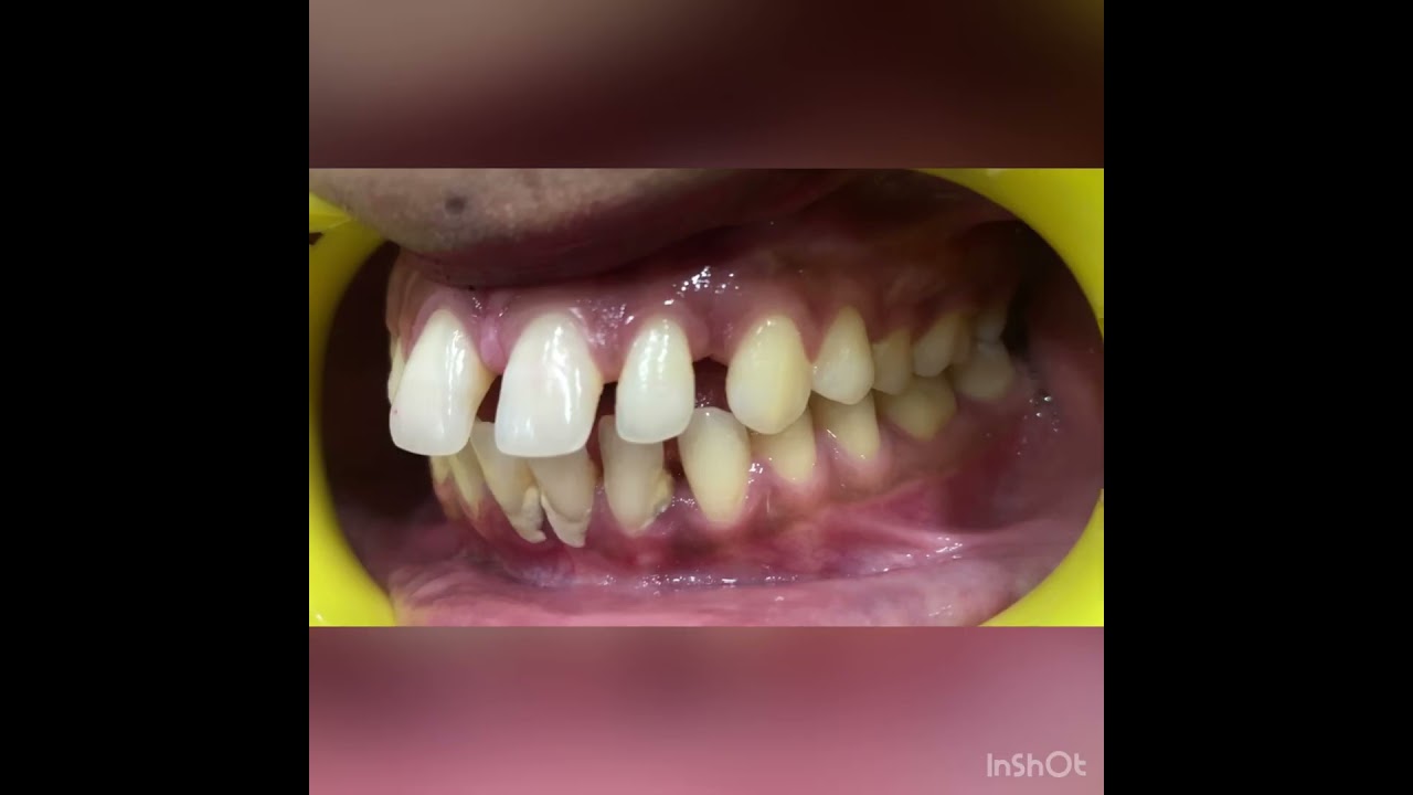 Orthodontic space closure#gap closure#orthodontic treatment #trending