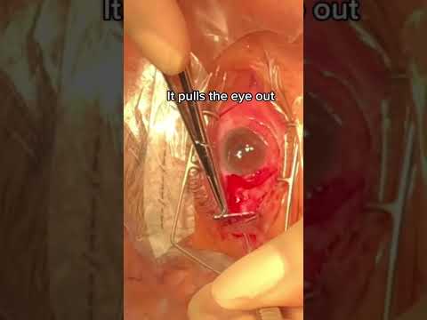 Eye muscle surgery #shorts #surgery #strabismus