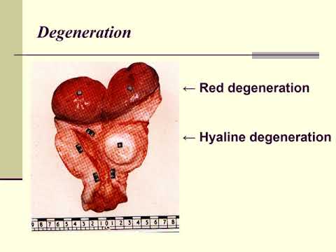 01 Uterine Fibroids#LETS TALK ABOUT MEDICINE