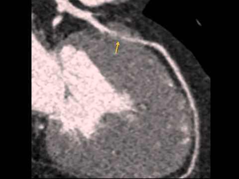 Coronary Artery Anatomy 7