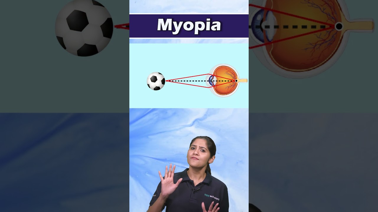 Eye defects - Myopia | Nearsightedness | What is Myopia (Short sightedness)? #shorts #mhboard2024