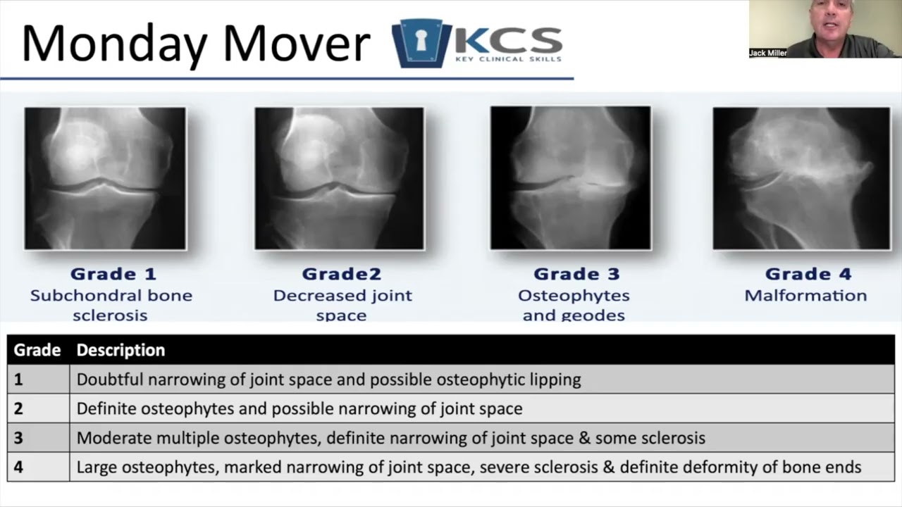 Knee OA and Radiology Reports