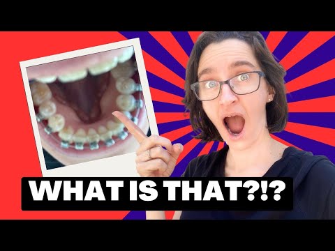 What the TORI is that?!? Boney growths in my lower jaw called Mandibular Tori