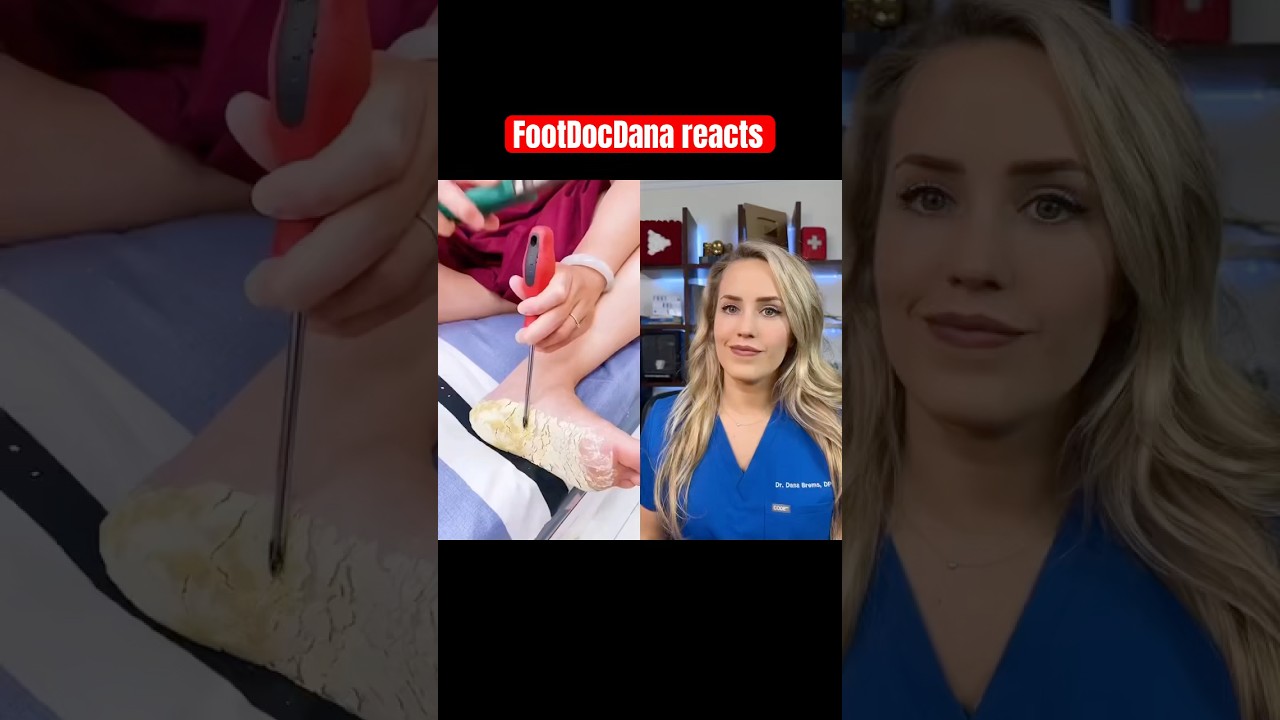 Doctor reacts to callus shaving device