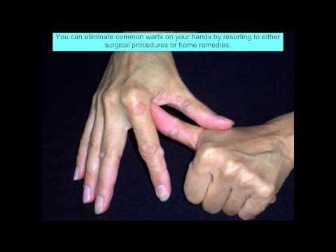 Pictures of Warts on Hands