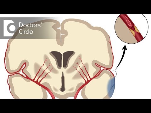 What are the types of Stroke?-Dr. C Udaya Shankar