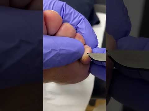 Watch Australian Podiatrist Remove Little Toe Pinch Callus | Expert Treatment with Docpods