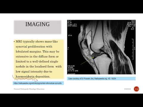 Pigmented Villonodular Synovitis - Pathology - Orthobullets