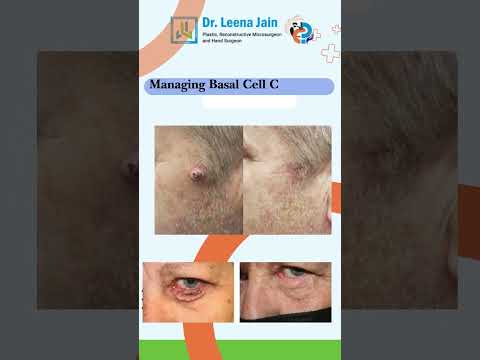 "Basal Cell Carcinoma (BCC): Symptoms, Causes & Treatment Options"