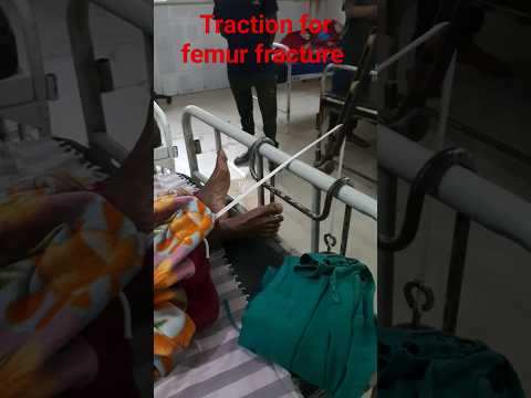 Traction for femur fracture