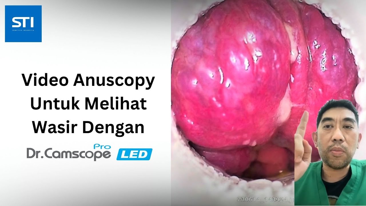 Video Anuscopy untuk Melihat Wasir dengan DCS Pro Video Rectoscope