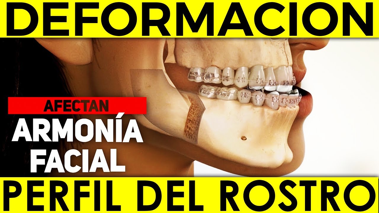 Los BRACKETS NO cambian la FORMA y el PERFIL DEL ROSTRO? Estos son los Beneficios de la ORTODONCIA