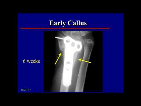 Normal Fracture Healing imaging findings