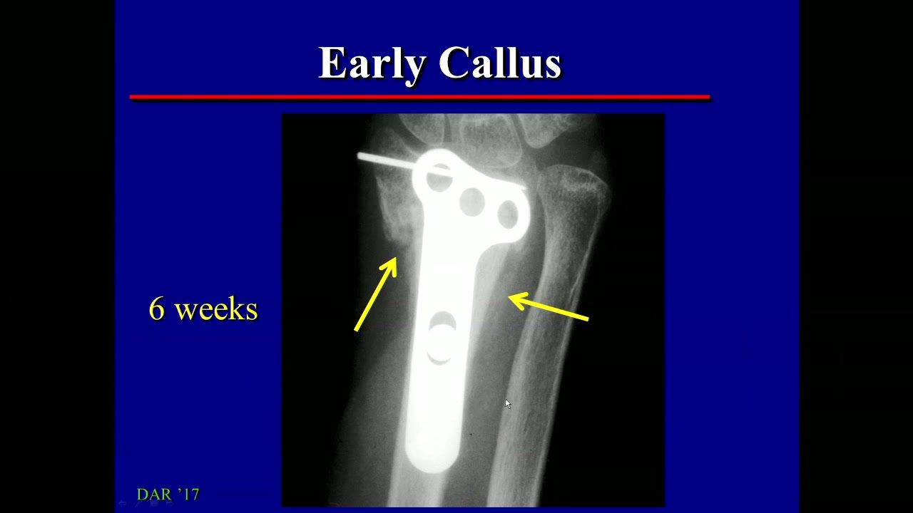 Normal Fracture Healing imaging findings