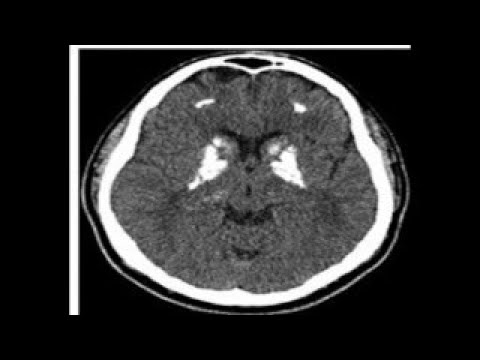 Treating brain calcifications (Fahr's Disease).Part 1