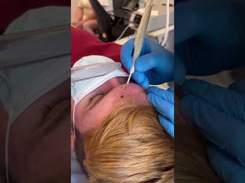 Watch A Forehead Mole Being Removed in 30 seconds!