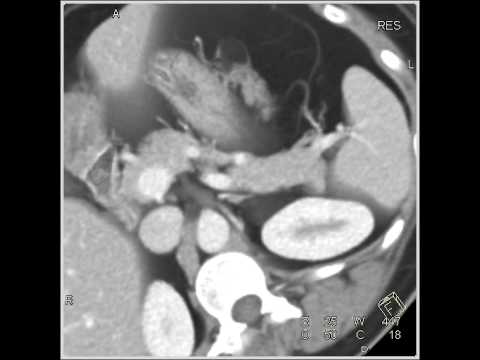 Abdomen: Kidney: evidence of an adenoma mass of the left adrenal gland(4 of 5)