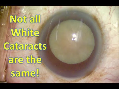 Dense White Cataract Surgery Technique (Non-Intumescent)