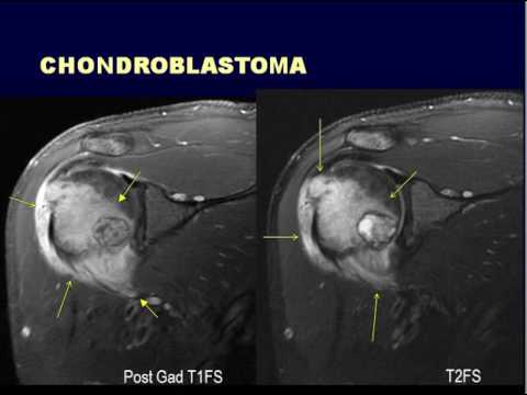 Radiographic Approach to Bone Lesions, Part II