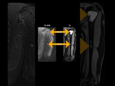 Humerus MRI, Fibrous Dysplasia