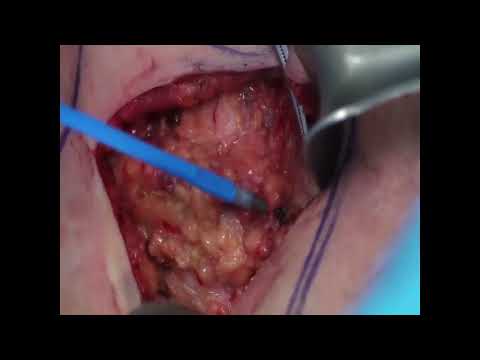 #026 Axillary Lymph Node Dissection Procedure Video | Cheap Ebooks