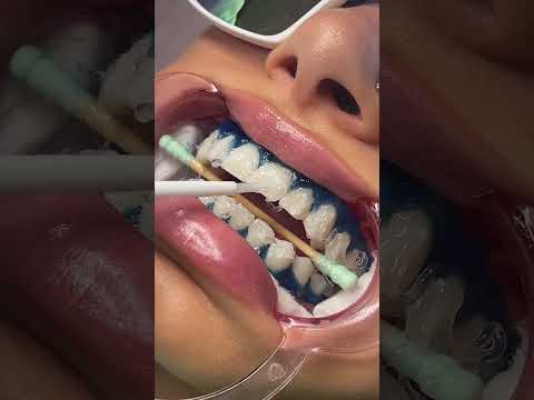 Teeth Whitening Process 🦷😱 #teethwhiteningprocedure #teethwhiteningbusiness #teethwhitening