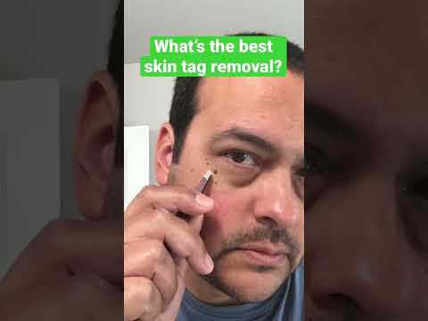 Best Skin Tag Removal At Home #shorts