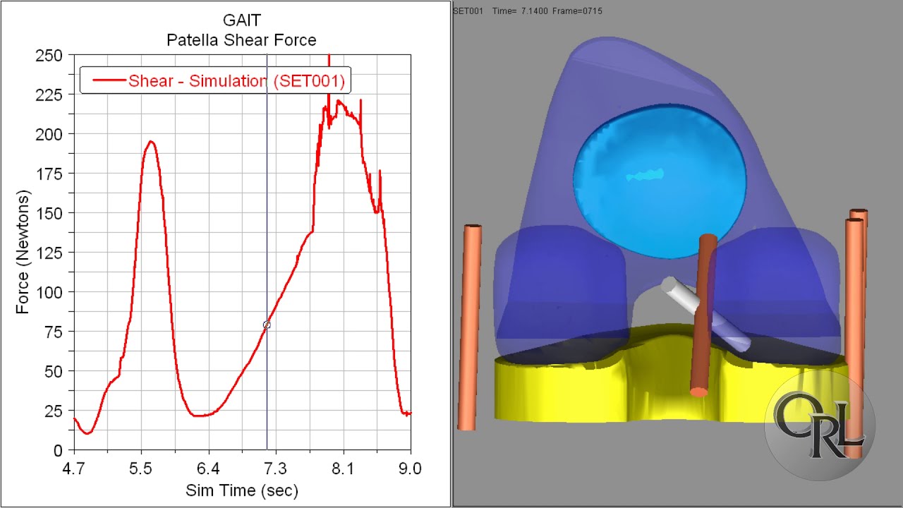Mechanical and Kinematic Alignment in Total Knee Arthroplasty: A Computational Kinematic Study