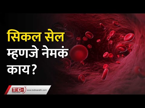Sickle Cell Anemia | सिकल सेल म्हणजे काय? | Sickle Cell Disease | Sickle Cell Symptoms #sicklecell