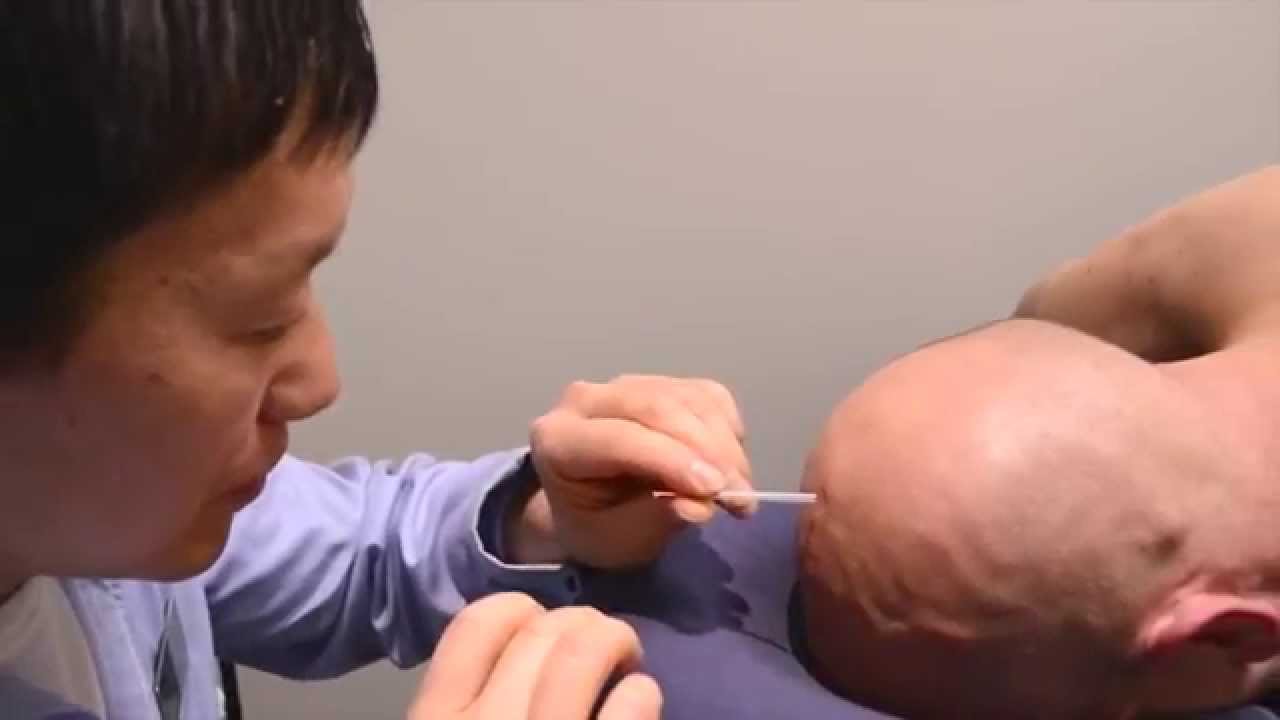 Acupuncture for Rehabilitation and Wellness at MRU