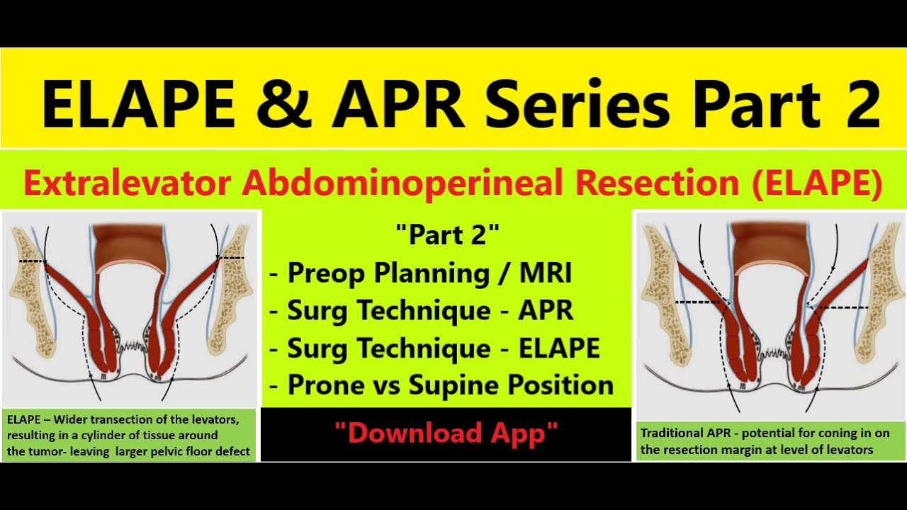 Extra Levator Abdominoperineal Excision Series Part 2/3. (See Video Description for Details).
