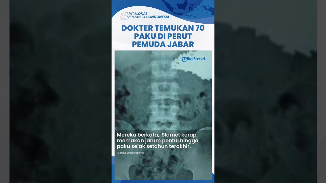 Dokter Kaget Temukan 70 Paku di Perut Pemuda saat Operasi, Pasien Akui ...