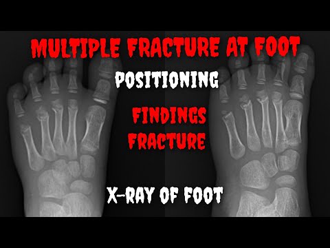X-Ray of foot AP and Oblique view || Fracture of foot || Foot X-Ray Findings || X-ray Diagnosis