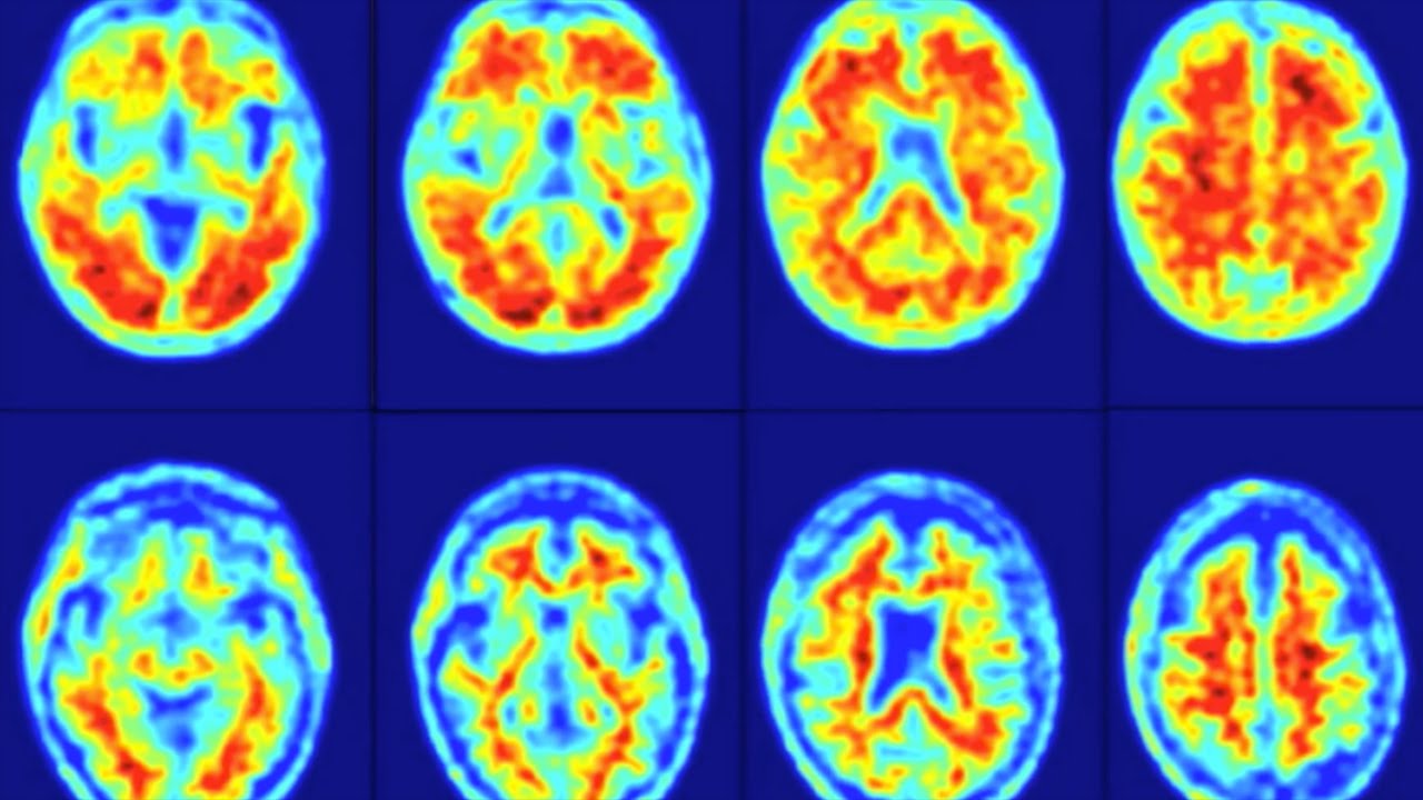 Trial aims to prevent Alzheimer’s in those genetically predisposed