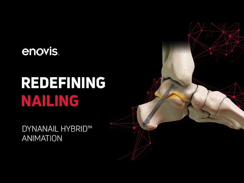 DynaNail Hybrid™ Fusion System Animation