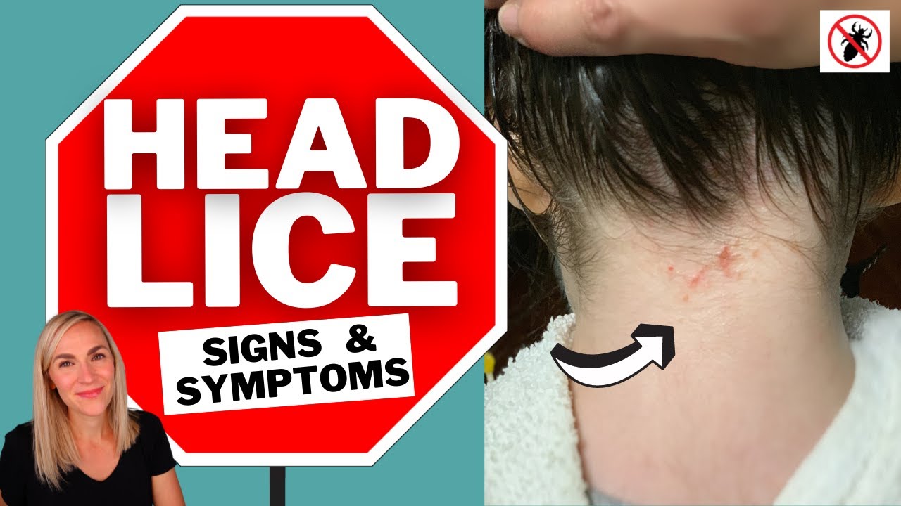 Lice Signs and Symptoms Video Tutorial