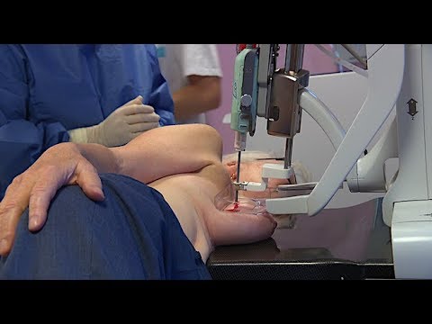 Breast cancer: a biopsy to confirm the diagnosis - Allô Docteurs