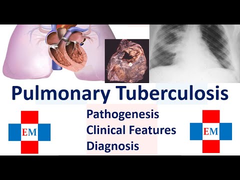 Pulmonary Tuberculosis (PTB)| Part-1 | Respiratory Lecture-5