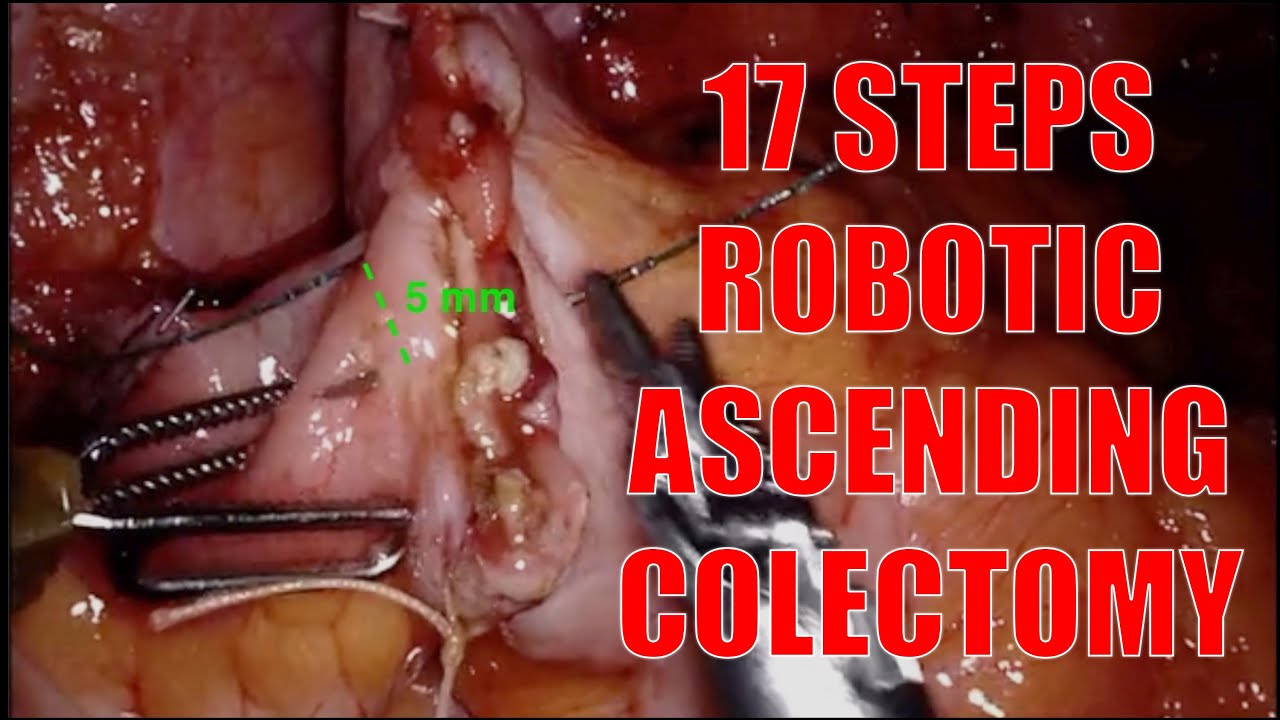 17 Steps of a Robotic Right / Ascending Colectomy with Intracorporeal Anastomosis