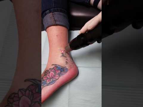 Schweiger Dermatology Group's Dr. Jeremy Fenton performs a tattoo removal